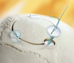 Craniofix3 – ROFRABSI Medical